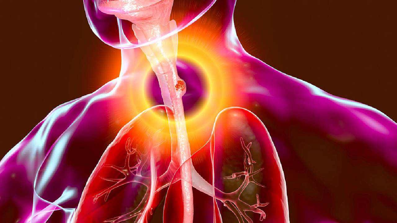 Esophageal Cancer ನಿತ್ಯ ಕಾಫಿ ಚಹಾದಂತಹ ಬಿಸಿ ಪಾನೀಯಗಳ ಸೇವನೆ ಕ್ಯಾನ್ಸರ್ ಗೆ ಕಾರಣವಾಗಬಹುದು ಎಚ್ಚರ